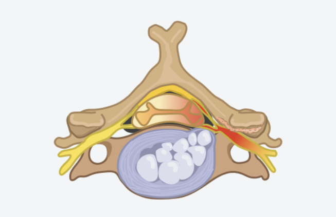 Anterior Cervical Discectomy - Huffman Spine Clinic